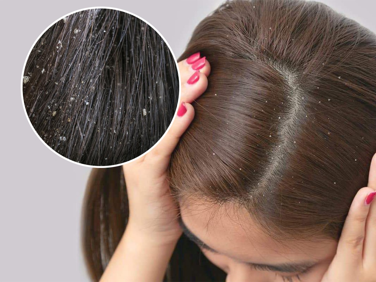 Home Remedy For Hair Dandruff Problem: केसात फार कोंडा झालाय, वैताग ...