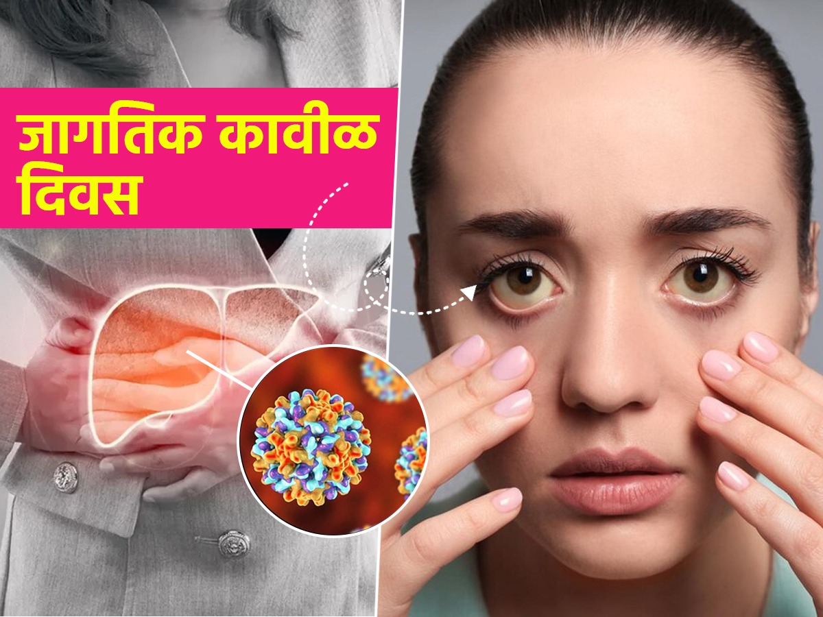 जागतिक कावीळ दिवस : हिपॅटायटीस बी म्हणजे नेमकं काय? शरीरसंबंधातून ...