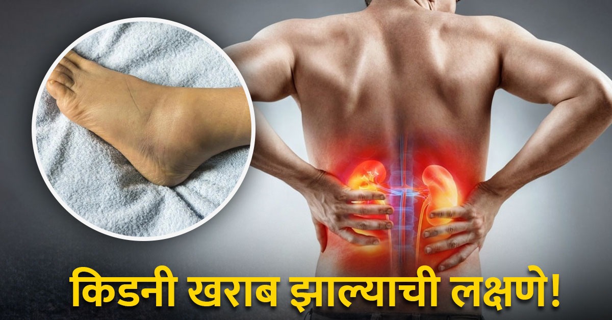 'या' 7 संकेतांवरून ओळखा किडनीमध्ये आहे समस्या, वेळीच व्हाल सावध तर ...