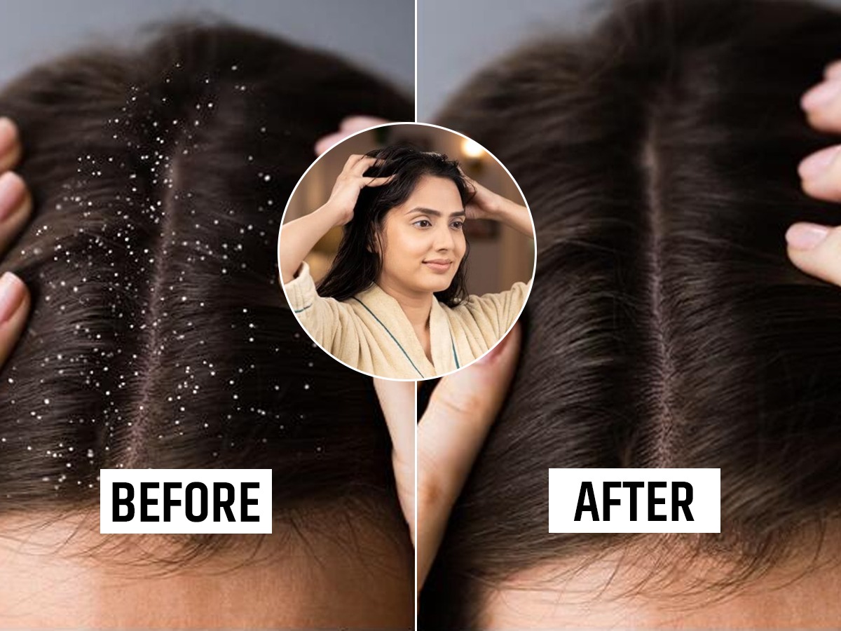 केसातल्या कोंड्यामुळे हैराण आहात? तज्ज्ञ सांगतात, आहारात करा ३ बदल ...
