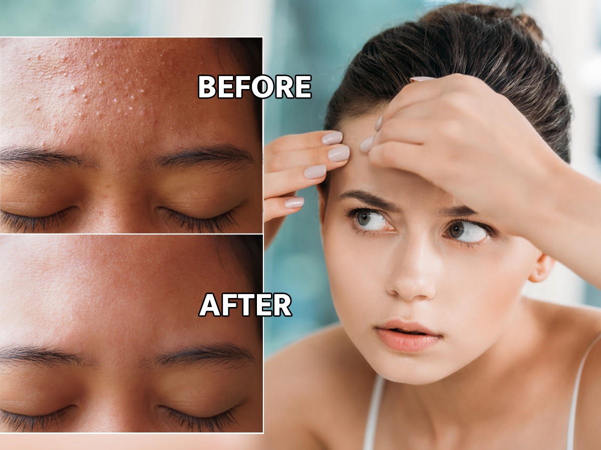 तुम्हालाही कपाळावर सतत बारीक पुरळ येते का? 4 सोपे उपाय, पुरळ होईल कमी ...