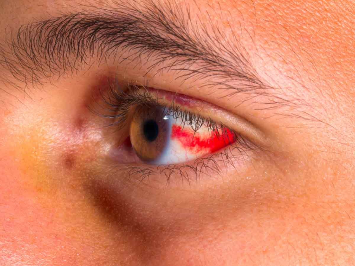 सावधान! Bleeding Eye व्हायरस म्हणजे काय? ८ दिवसांत होतो रुग्णाचा मृत्यू ...