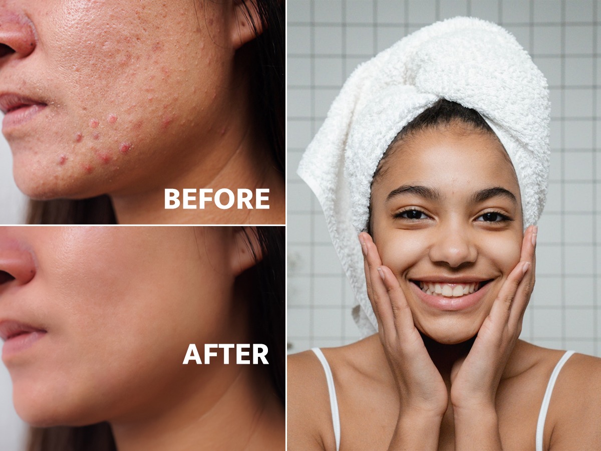 पिंपल्सचे काळे डाग चेहऱ्यावर वाईट दिसतात? विकेंडला करा ४ सोपे उपाय ...