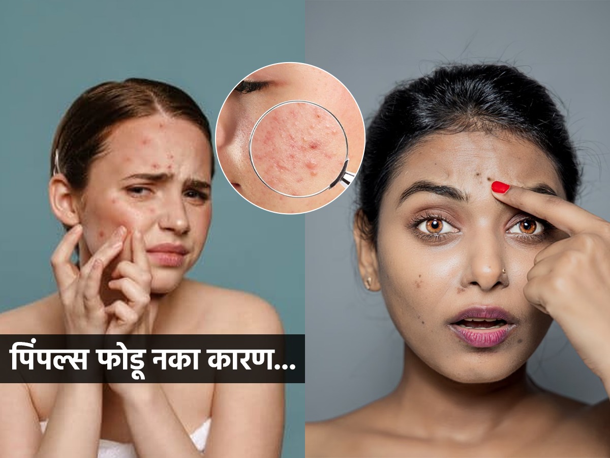 चेहऱ्यावरचे पिंपल्स नखाने फोडताय ही सवय सोडा नाहीतर चेहरा कायमचा होईल खराब कारण Marathi