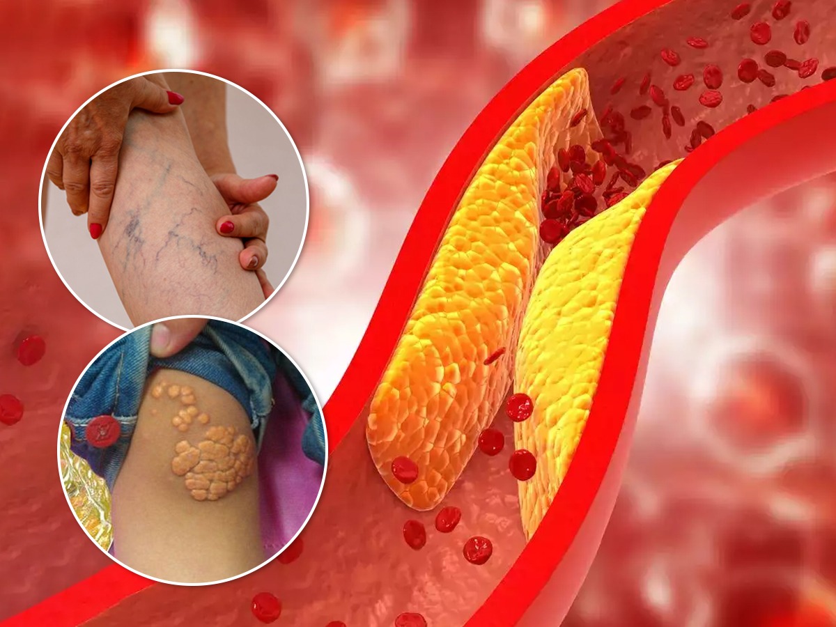 बॅड कोलेस्टेरॉल वाढल्याच्या पायांवर दिसतात ६ खुणा, वेळीच लक्षणं ओळखा ...