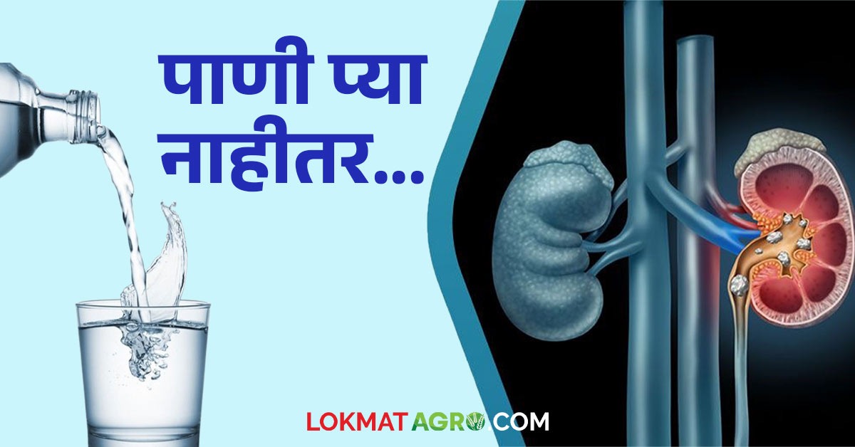 Mutkhada : उन्हाळ्यात किडनी स्टोन मुतखड्याचा धोका का वाढतो? जाणून घ्या ...