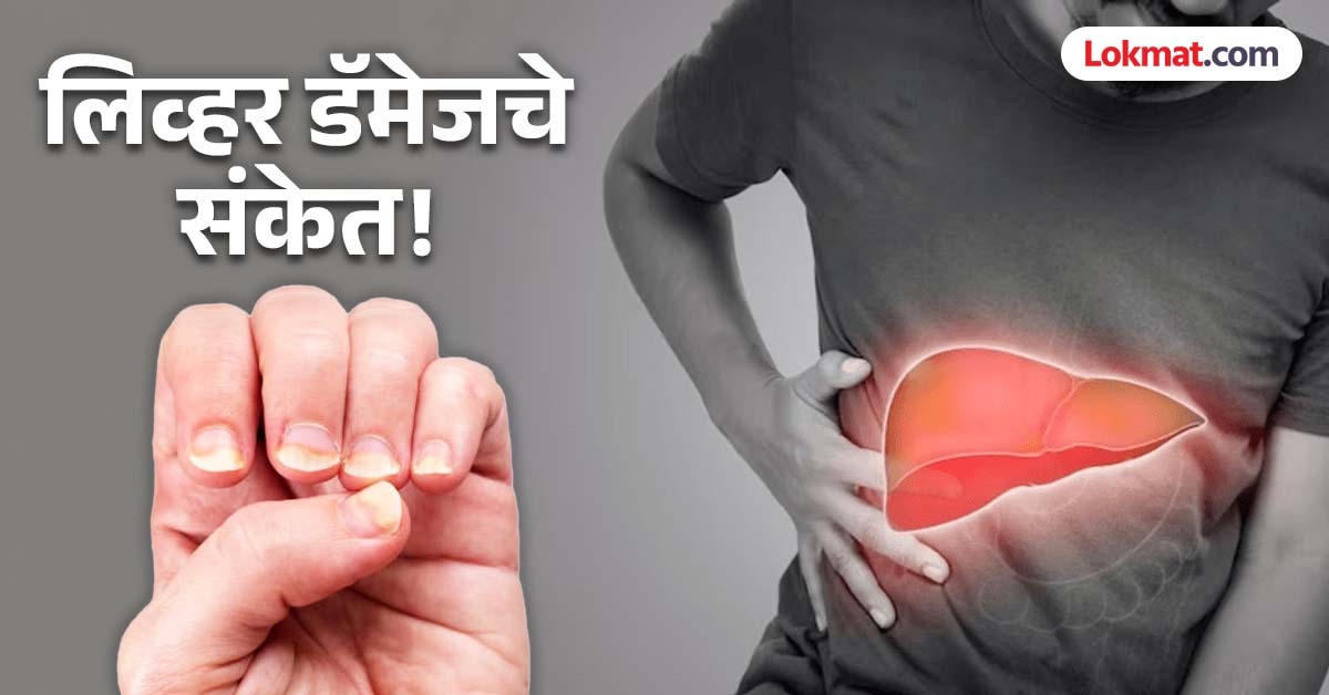 लगेच चेक करा हात आणि पायांची नखं, आकार-रंगात बदल आहे लिव्हर डॅमेजचा ...