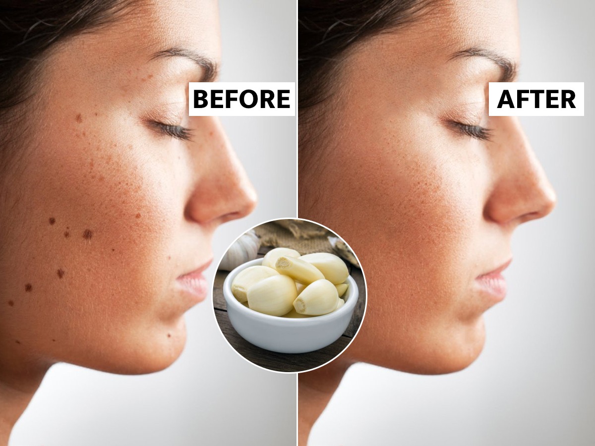 चेहऱ्यावर खूप तीळ आहेत? चामखीळही आहे? पाहा लसणाचे ३ सोपे उपाय, तीळ ...