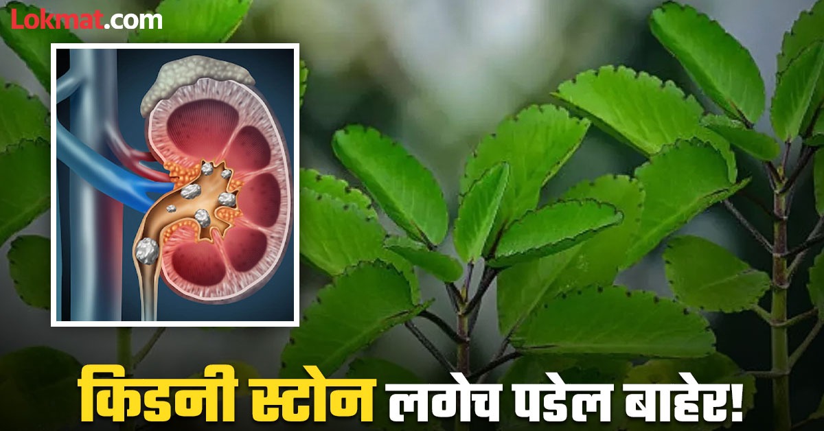 'या' एका आयुर्वेदिक उपायने किडनी स्टोनचे होतील तुकडे तुकडे, जाणून घ्या ...