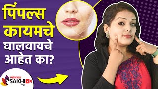 पिंपल्स पासून झटपट सुटका कशी मिळवायची | How to Remove Pimples Naturally ...