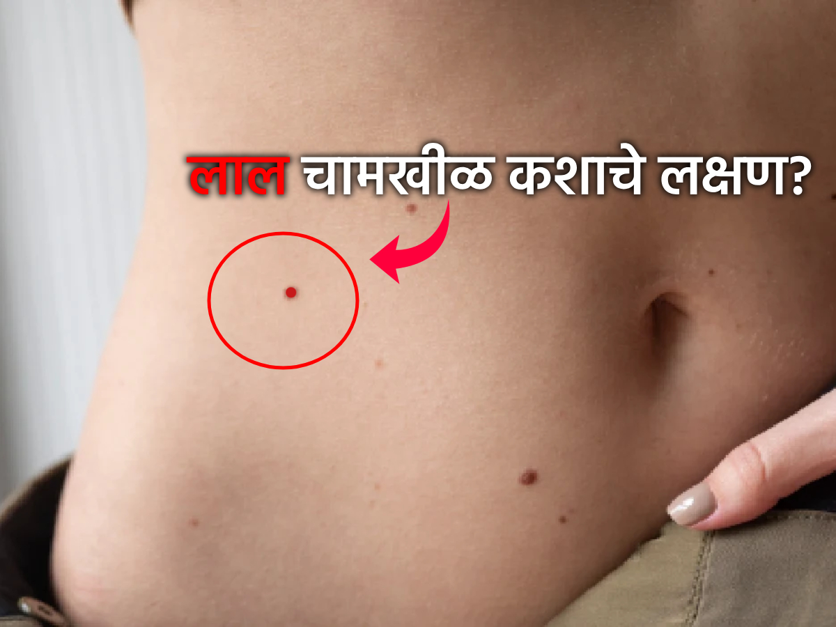 त्वचेवर लाल चामखीळ (Red Moles): ते कशाचे लक्षण आहे? त्यात काळजीचे कारण ...
