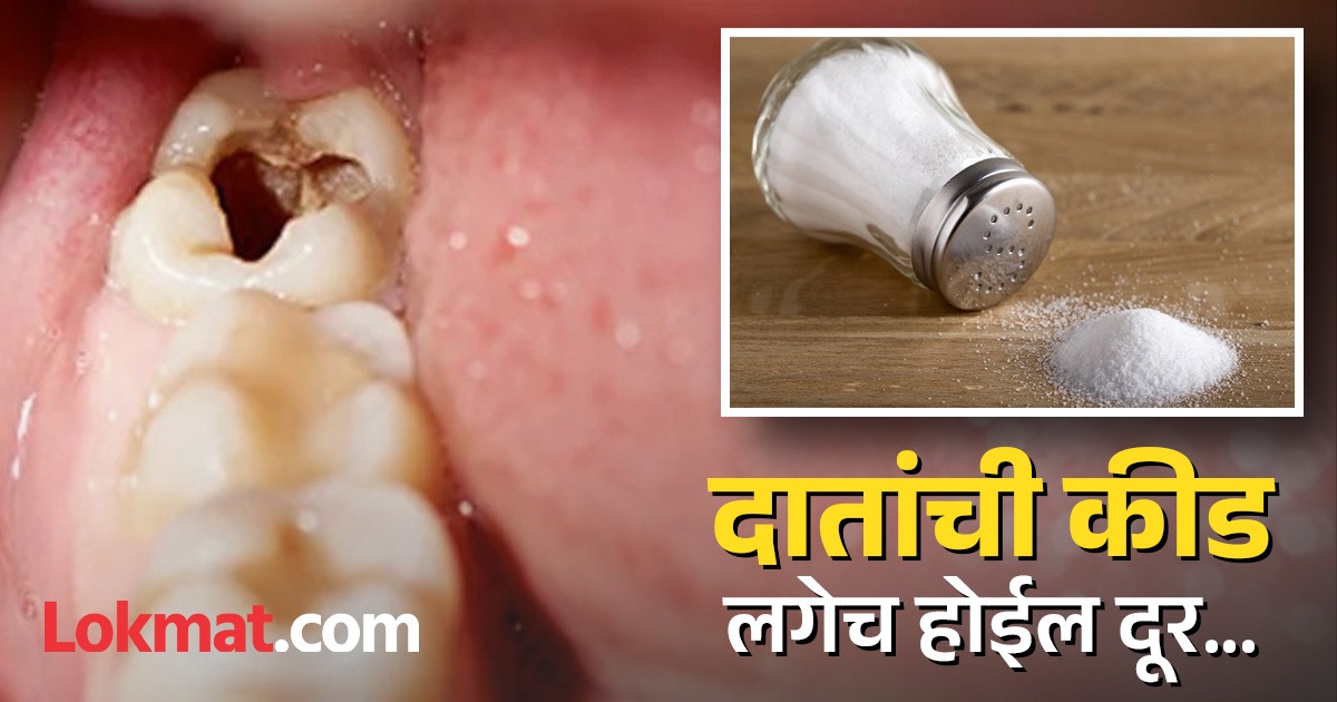 मिठात 'ही' एक गोष्ट मिक्स करून दातांवर लावाल तर दूर होईल कीड आणि असह्य ...