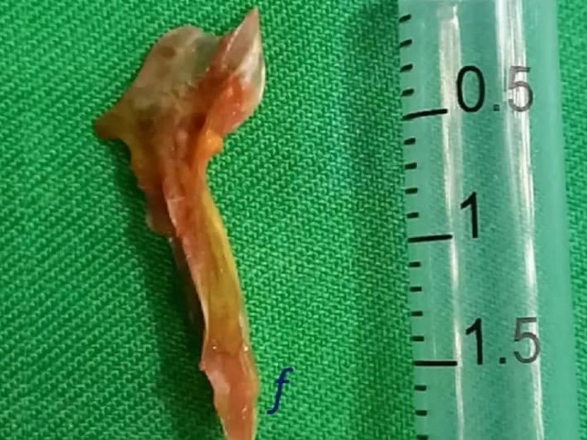 धक्कादायक! एक इंच माशाचा काटा गिळल्याने शेतकऱ्याचा मृत्यू, नेमक काय ...