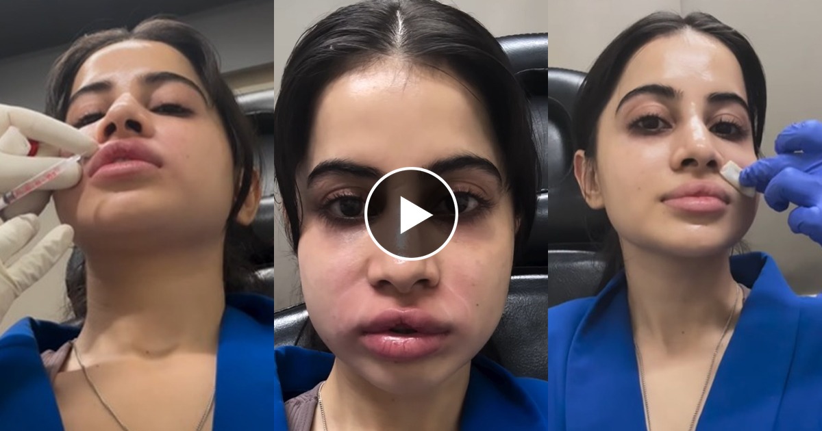 Urfi Javed Gets Lip Filler Dissolved Video Viral