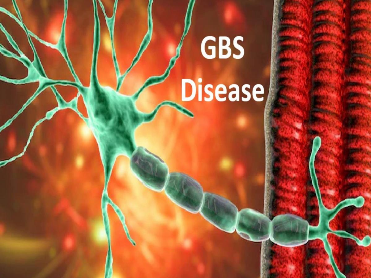 Pune GBS outbreak : जीबीएस रुग्णांमध्ये पुन्हा वाढ; ४७ रुग्ण आयसीयूत ...