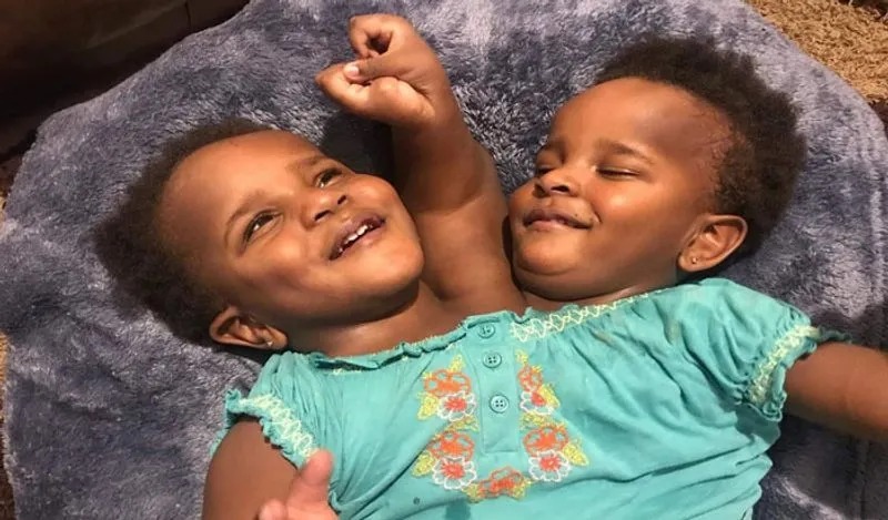 दोघी बहिणींच्या शरीरात होत्या ३ किडन्या; जन्माला येताच डॉक्टरांनी केली ...