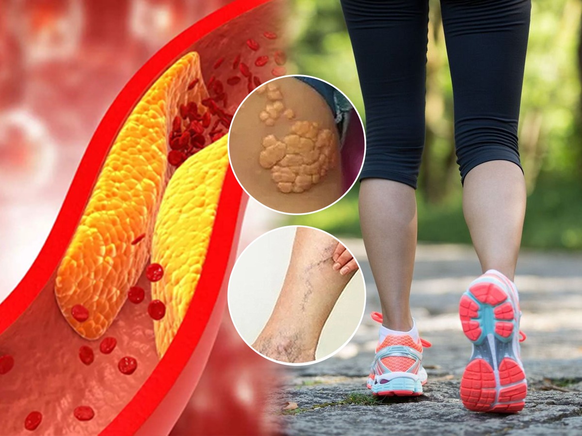 Cholesterol Symptoms : कोलेस्टेरॉल वाढल्याचं सांगतो चालताना पायांमध्ये ...