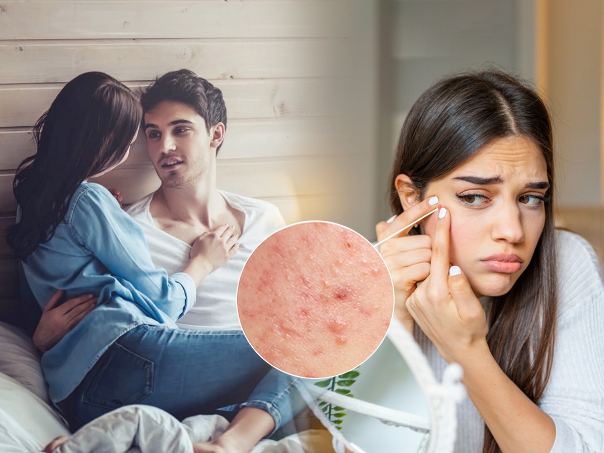 सेक्समुळे चेहऱ्यावर पिंपल्स येण्याचे प्रमाण वाढते का डॉक्टर सांगतात 7769