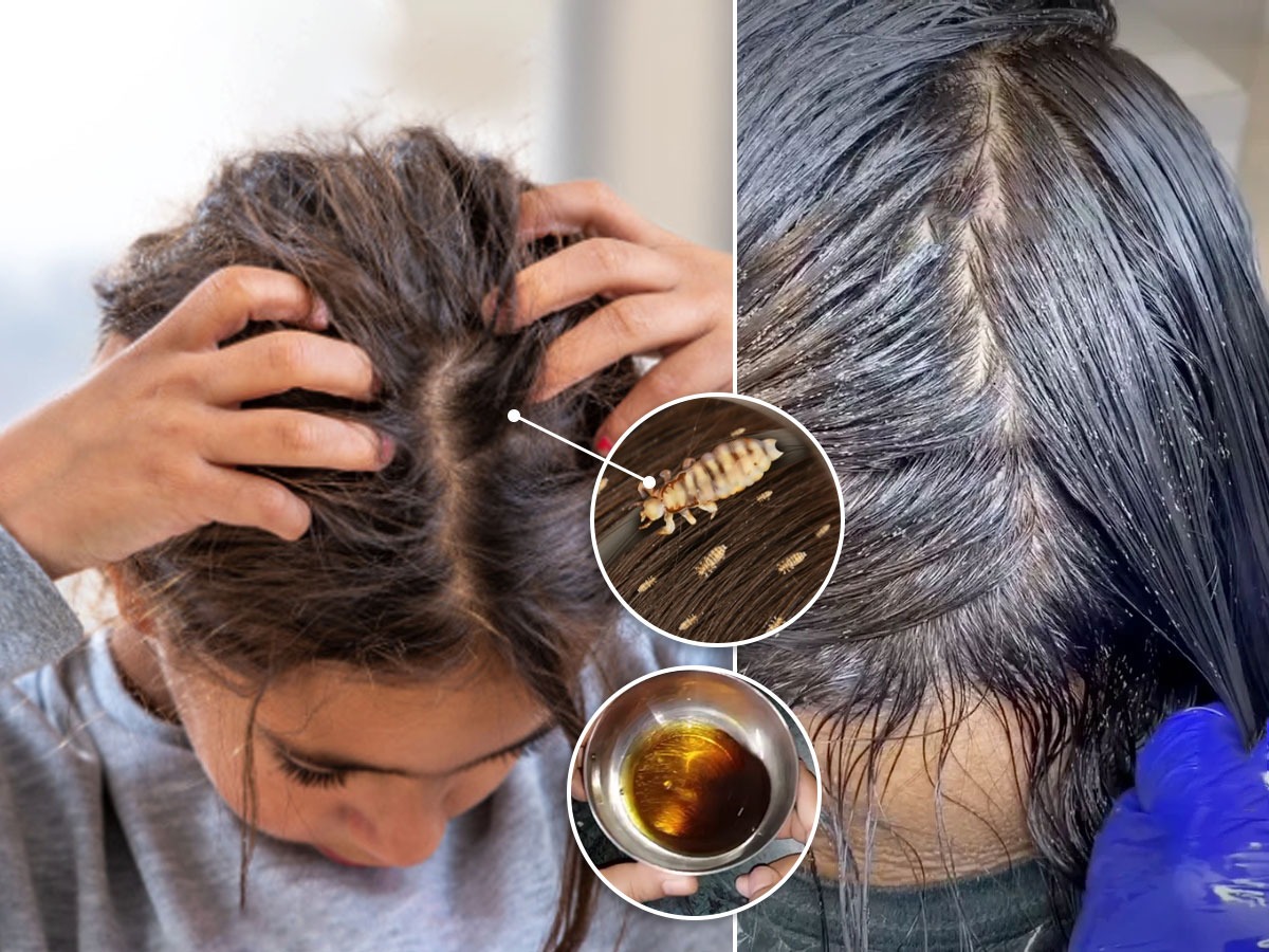 दिवसरात्र खाज येते, केसात उवा-लिखा असण्याची भिती वाटते? सोपा उपाय, उवा ...