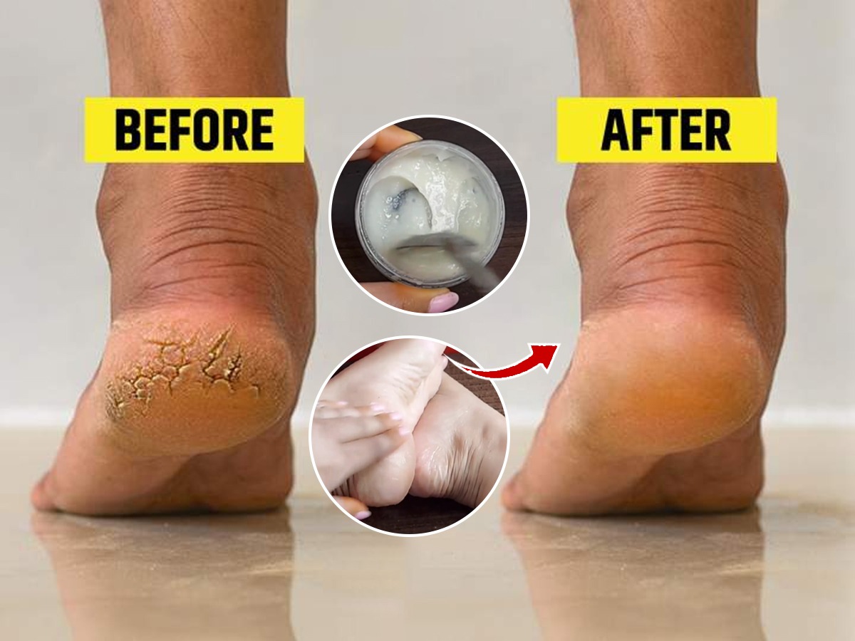 थंडीत टाचा फुटतात, बघा १ घरगुती उपाय - दुखणे होईल बंद - घाला स्टायलिश ...