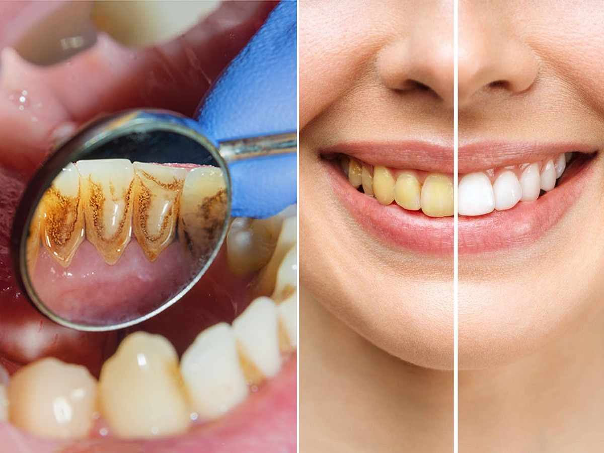 दातांवर पिवळा थर आलाय, दुर्गंध येतो? किचनमधल्या ४ गोष्टींनी दात घासा ...