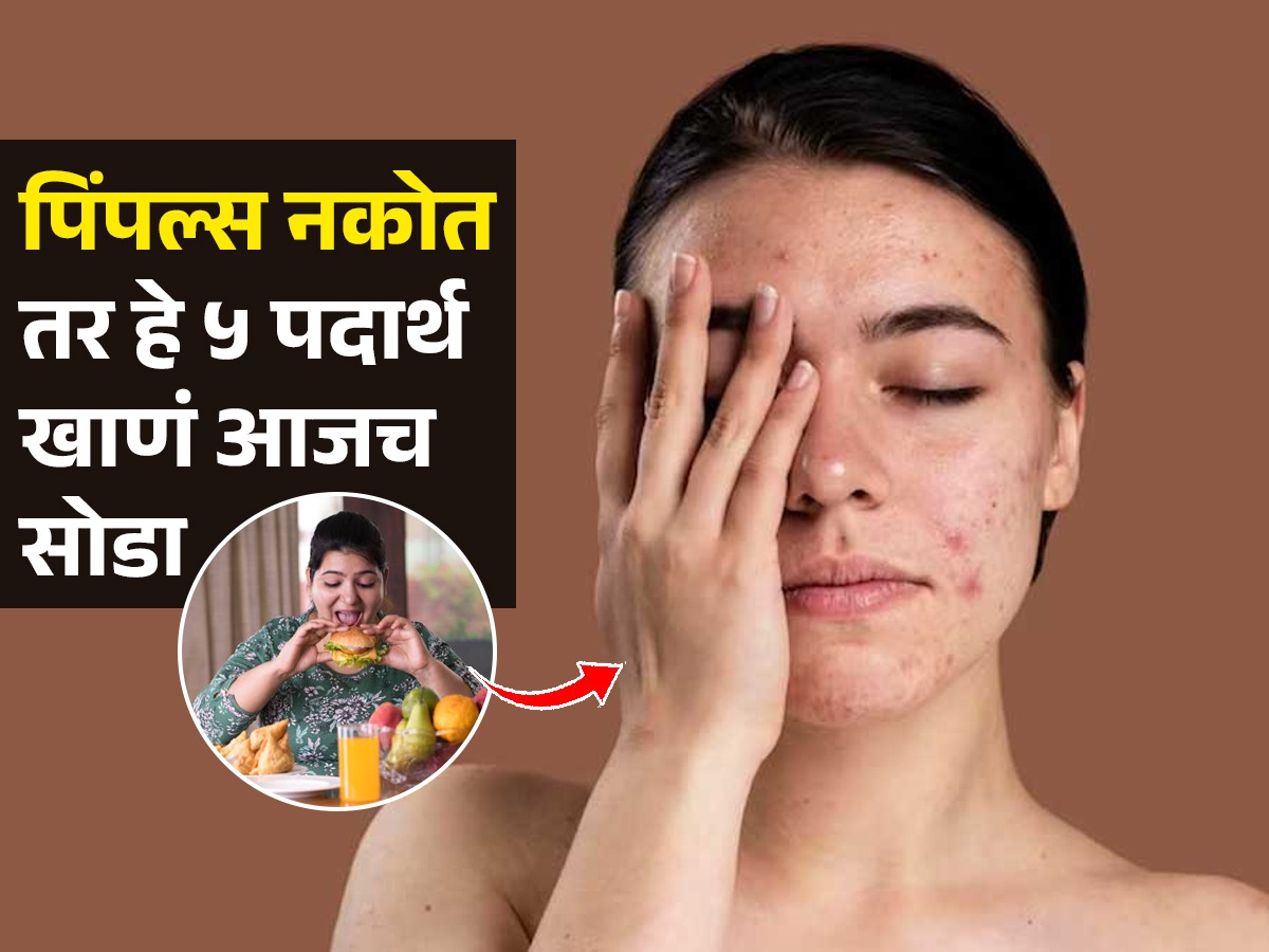 उष्णतेमुळे चेहऱ्यावर सतत पिंपल्स येतात? ५ पदार्थ खाणं सोडा, पुळ्या-डाग ... उष्णतेमुळे चेहऱ्यावर सतत पिंपल्स येतात? ५ पदार्थ खाणं सोडा, पुळ्या-डाग ...