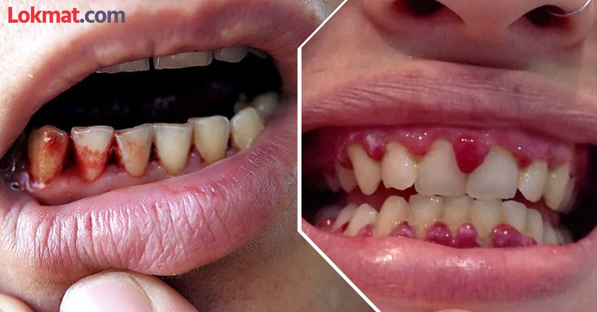 दात गळतात, हिरड्यांतून रक्तस्राव; 'स्कर्वी' आजार कशामुळे होतो ...
