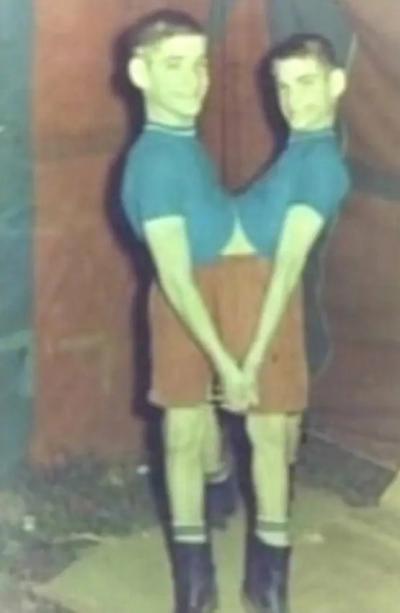 SEE PICS! World's longest-surviving conjoined twins die together at the ...