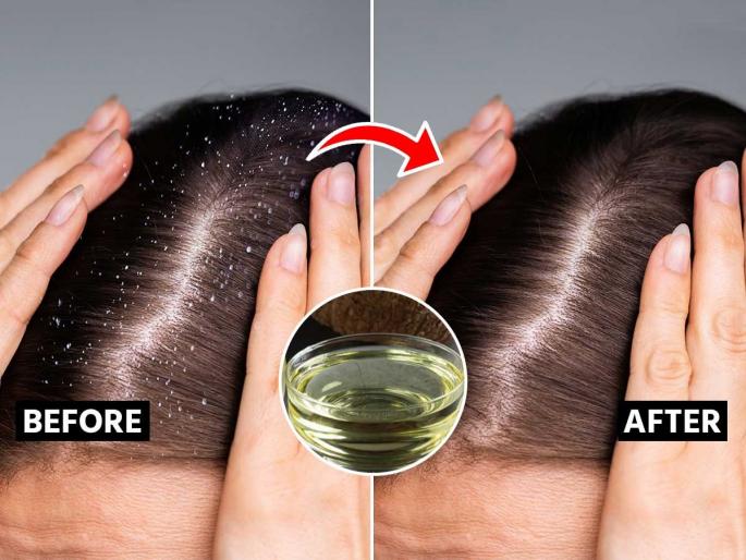 कोंडा गायब होऊन केस वाढतील झरझर! तमालपत्रांच्या पानांचे हेअर सिरम ...