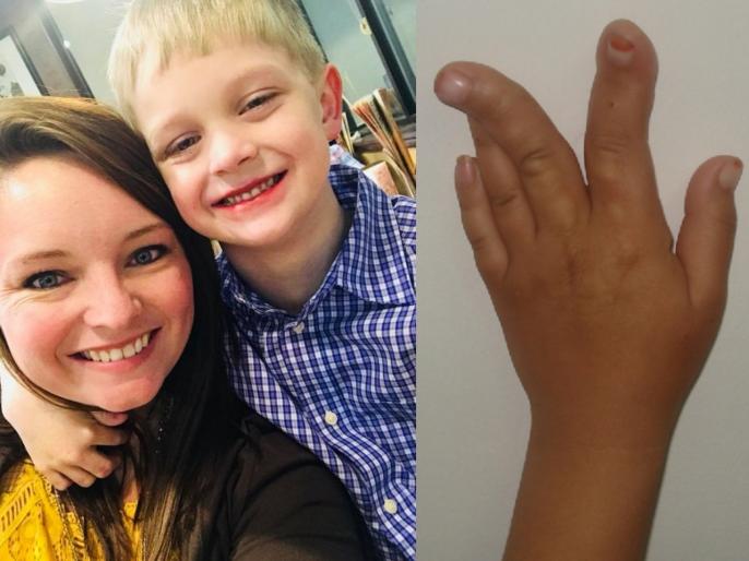 'या' वयात अवयवांचा आकार वाढल्याने प्रोटीस सिंड्रोमचा असू शकतो धोका ...