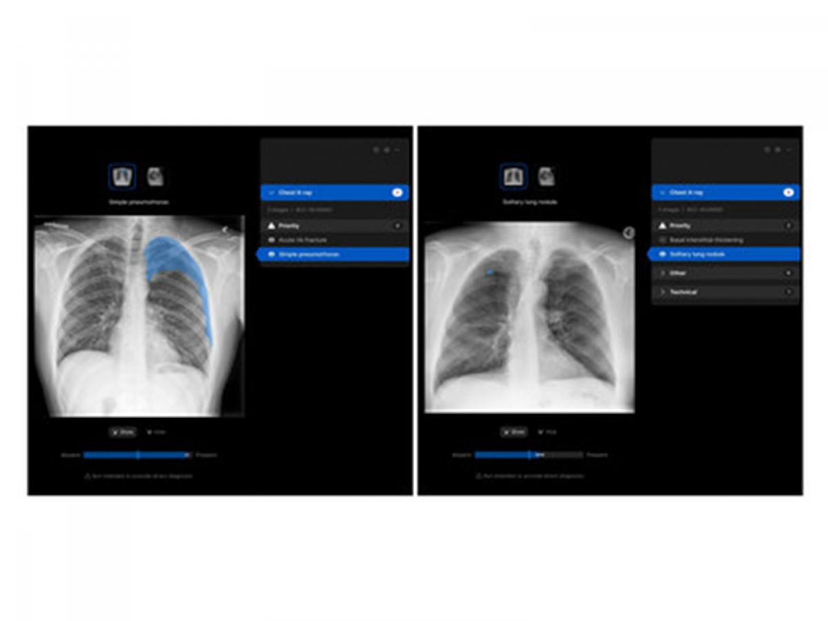 Manipal Hospitals Adopts Harrison.ai's chest X-ray AI to improve ...