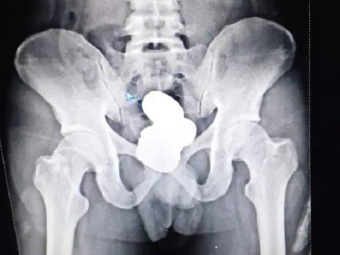 Man with 900 grams gold worth Rs 42 lakh concealed in rectum arrested ...
