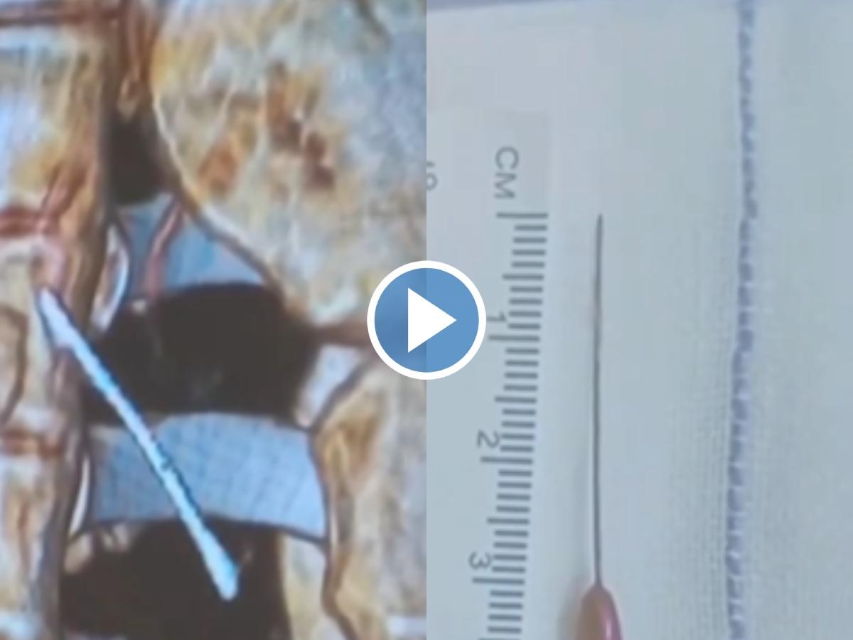 14-year-old Mistakenly Swallows 4 cm long Needle, Tamil Nadu Doctors ...