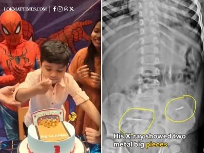 Thane Shocker: 3-Year-Old Accidentally Swallows Metal Pins With ...