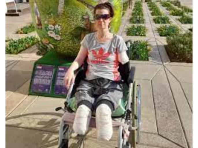 Woman Who Went To Hospital With Stomach Ache Loses Arm And Both Legs