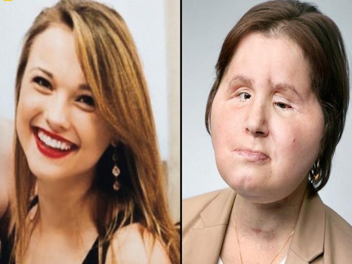 Katie Stubblefield Becomes The Youngest Person Ever To Receive A Face ...