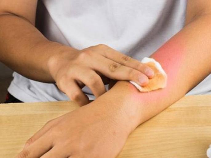 These home remedies will help you to get rid of burn marks and unwanted ...